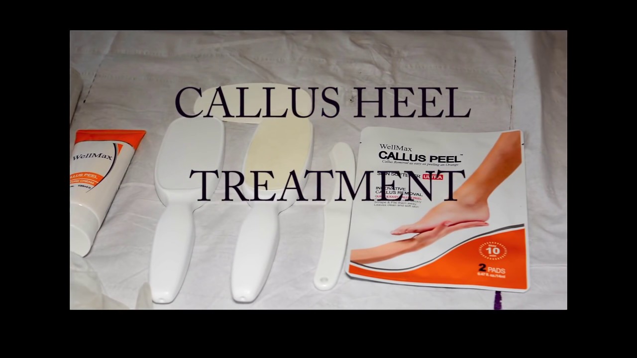 Callus Heel treatment - YouTube