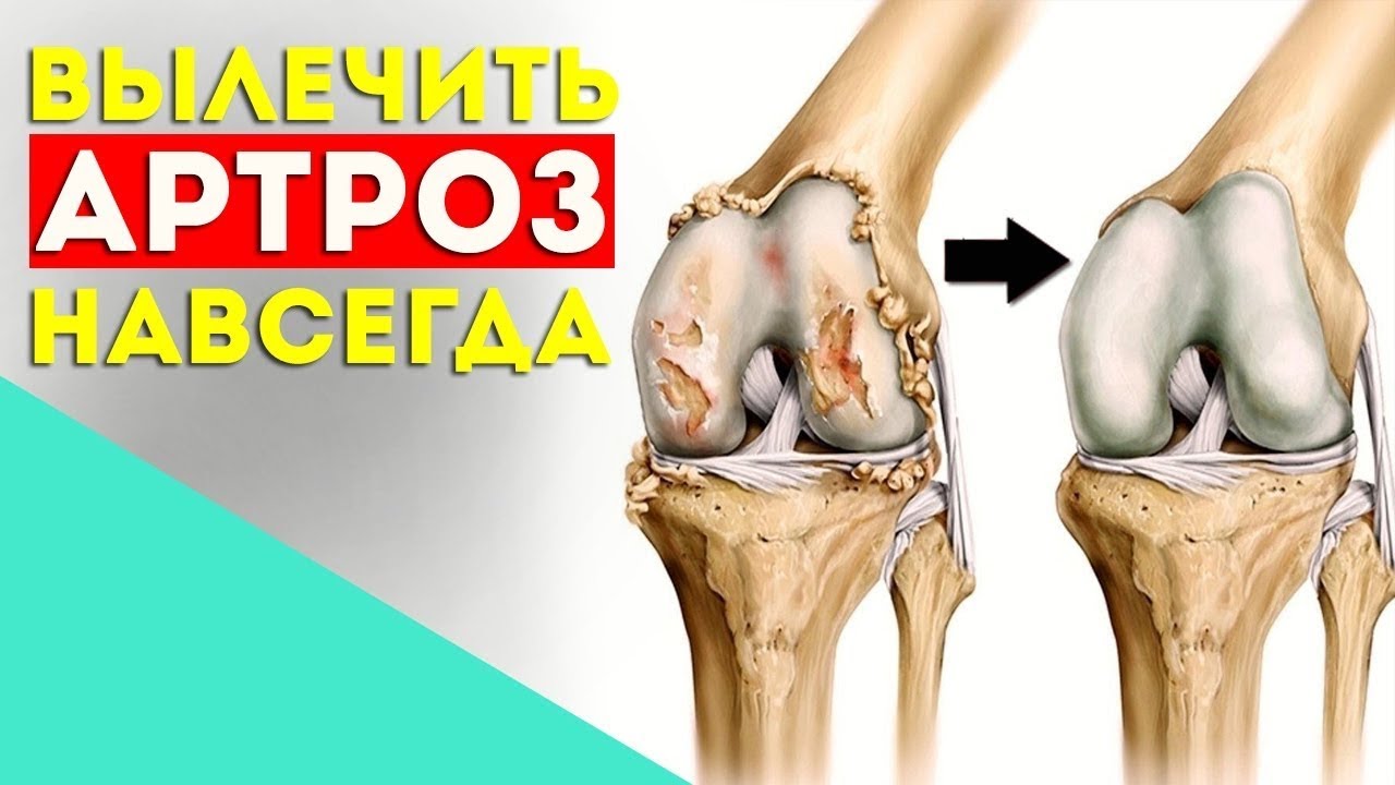 Тізе буынындағы артрит артрозға арналған жаттығу Упражнение при артрозе