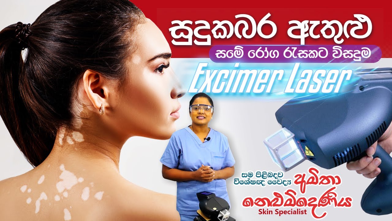 සුදුකබර ලප නැතිකරන Excimer Laser | Skin Specialist - YouTube