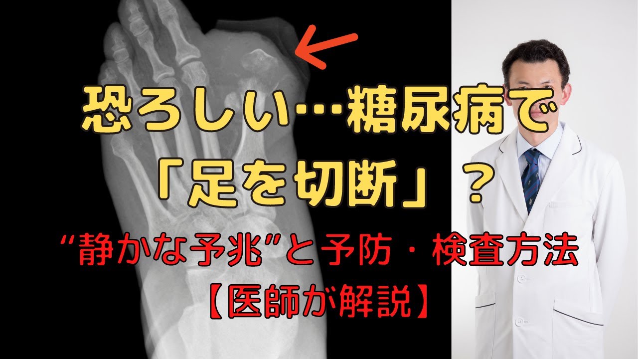 糖尿病で「足を切断」?“静かな予兆”と予防・検査方法【医師が解説】 Youtube