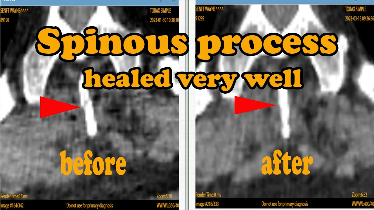 Broken spine follow up CT scan results - YouTube