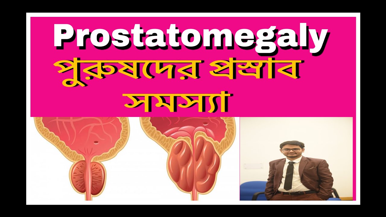 প্রোস্টেট বাড়া // Prostatomegaly // Management & Tips - YouTube