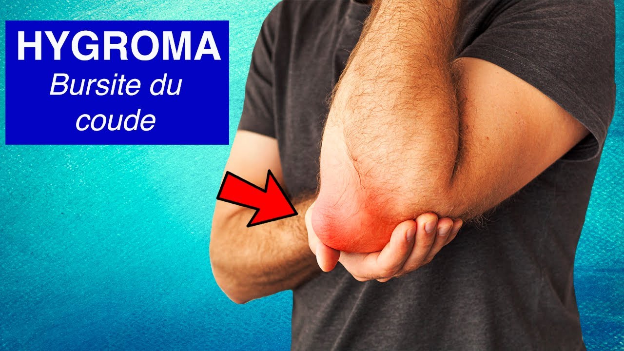 Bursite du coude (Hygroma) : Symptômes, diagnostic et traitements - YouTube