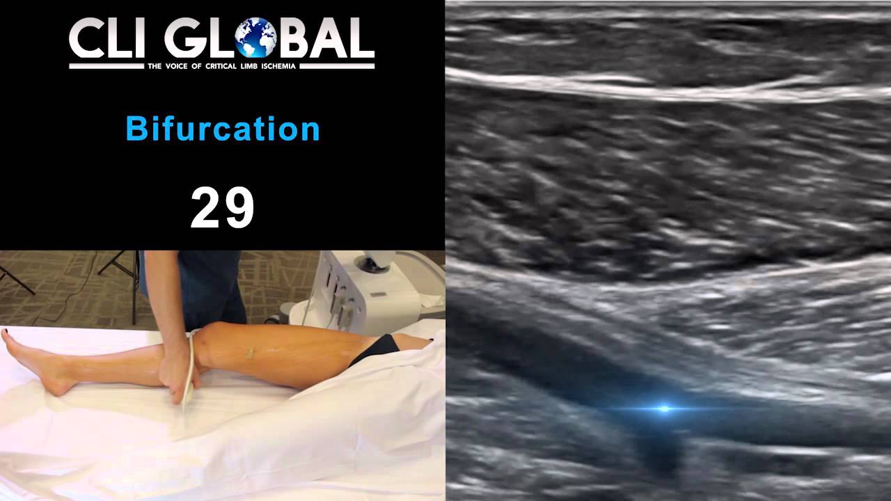 Ultrasound Scan Of The Leg In 60 Seconds - YouTube