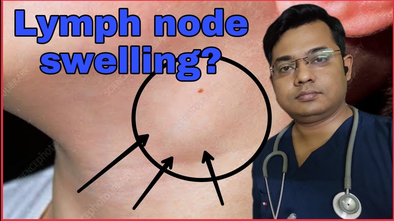 Causes of lymph node swelling and treatment|Lymphoma|Doctor on YouTube ...