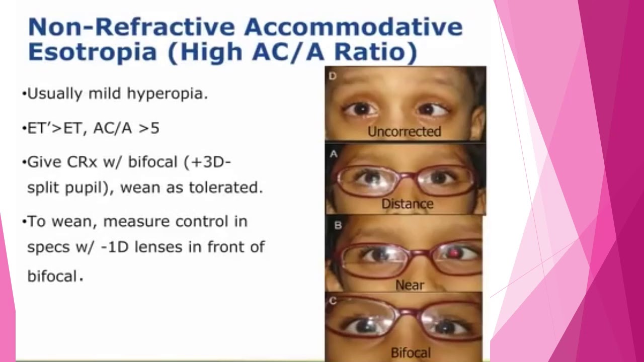 Accommodative esotropia - YouTube