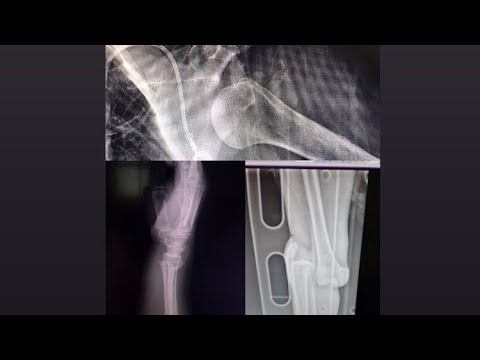 ACİL SERVİSTE KIRIK ÇIKIK YÖNETİMİ PÜF NOKTALARI