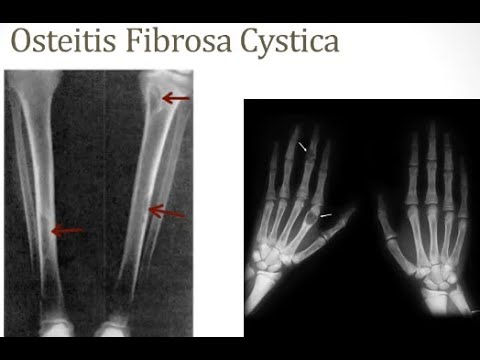 Osteitis fibrosa cystica ; Definition, Causes, Symptoms, Diagnosis ...