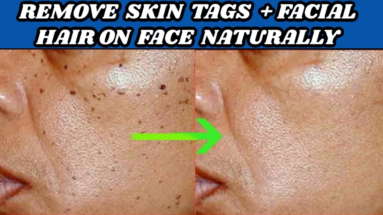 HOW TO REMOVE SKIN TAGS + FACIAL HAIR ON FACE NATURALLY | 25 DAYS ...
