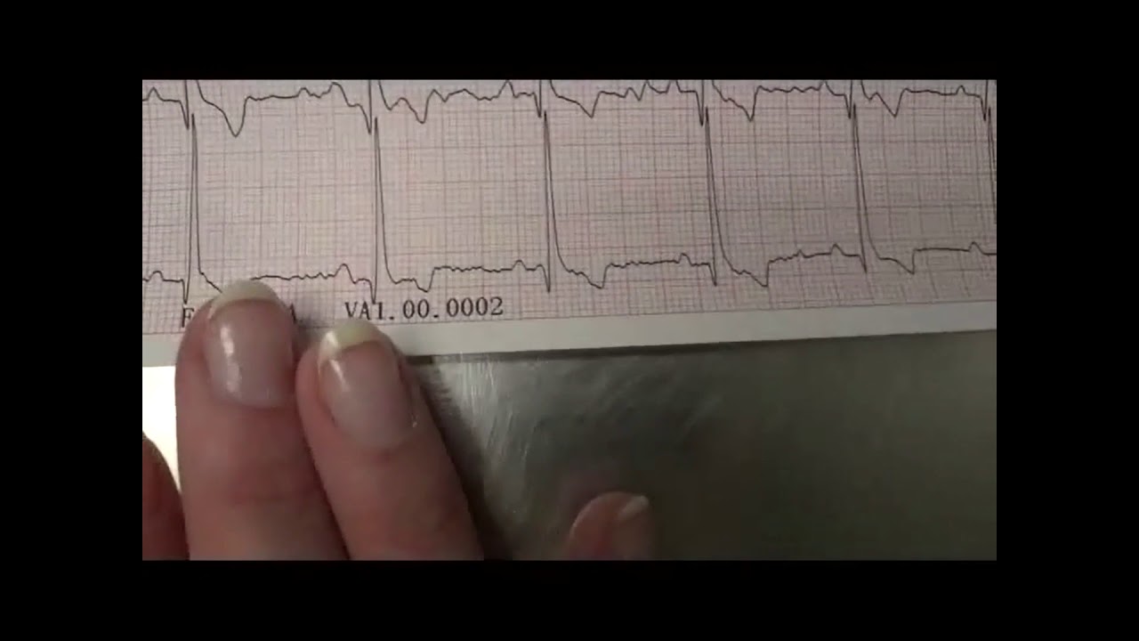 ECG Video - YouTube