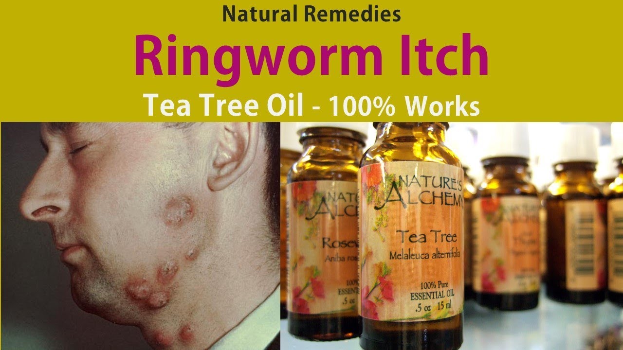 Natural Remedies Ringworm Itch -Stop Ringworm With Tea Tree Oil - 100% ...