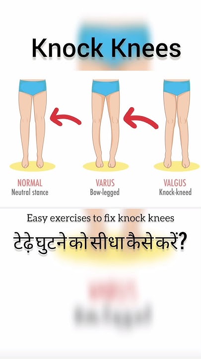 How To Fix Knock Knees Which Asana To Do To Cure Varus Vagus Youtube