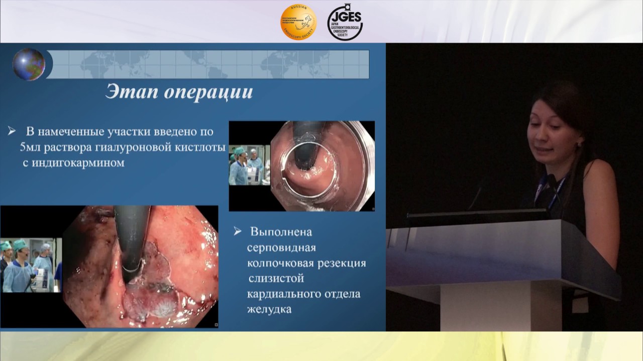 Отдаленный результат операции профессора Haruhiro Inoue (кардиопластика ...