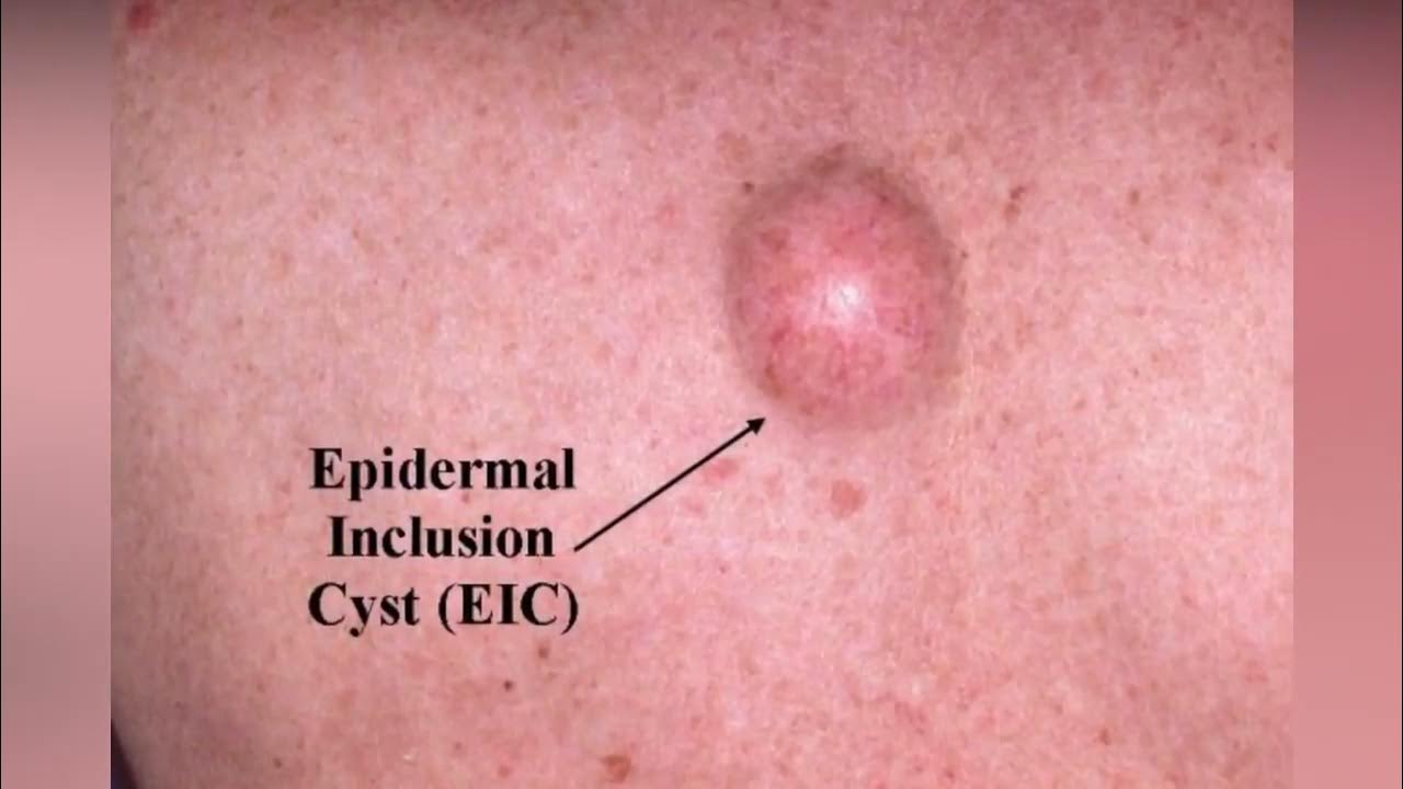 Dermoid Cysts Treatment Prevention And Excision Youtube