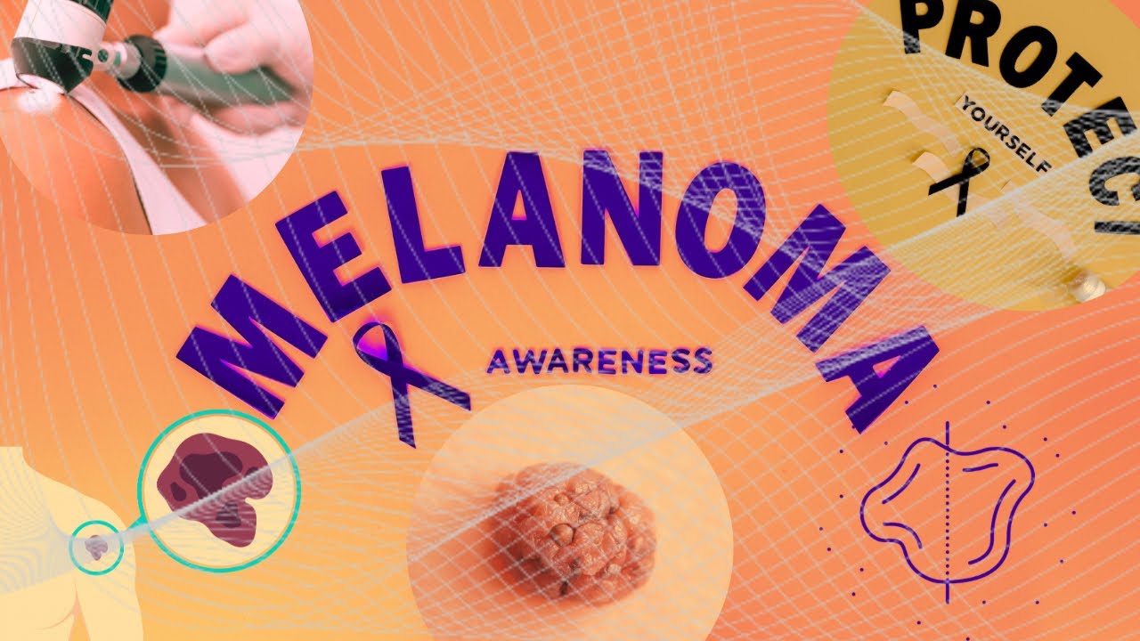 Spotting the ABCDE Red Flags of Melanoma - YouTube