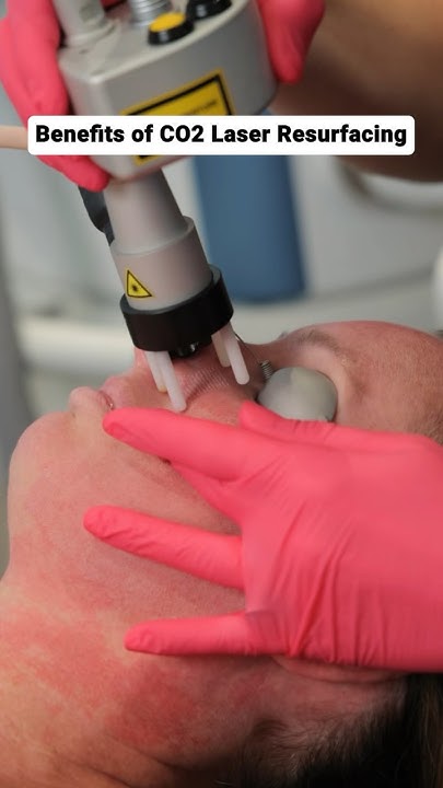 CO2 Laser Resurfacing Benefits #antiaging #skincare - YouTube