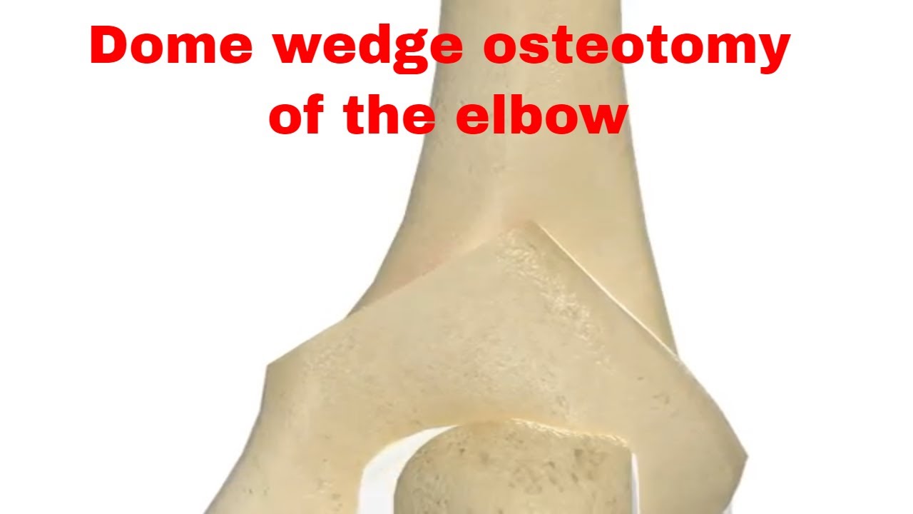 Dome wedge osteotomy of the elbow - YouTube