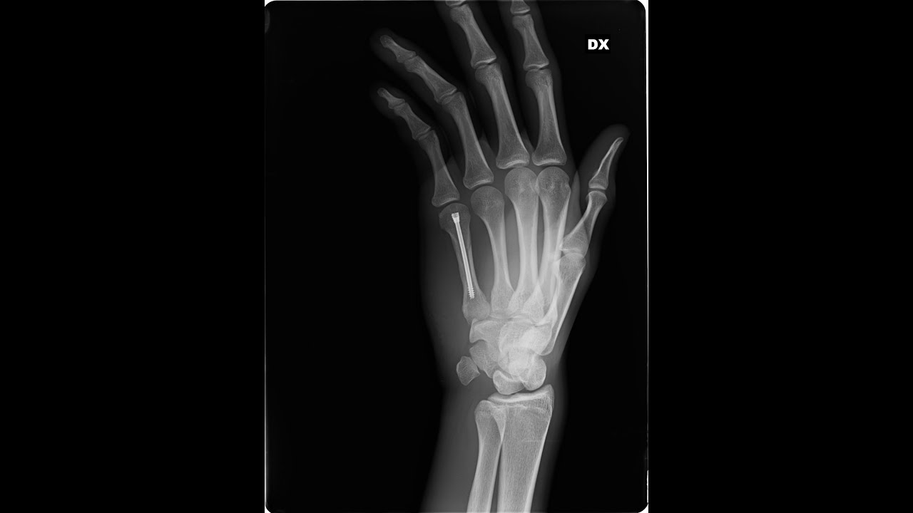 Percutaneous intramedullary screw fixation of metacarpal and phalangeal ...