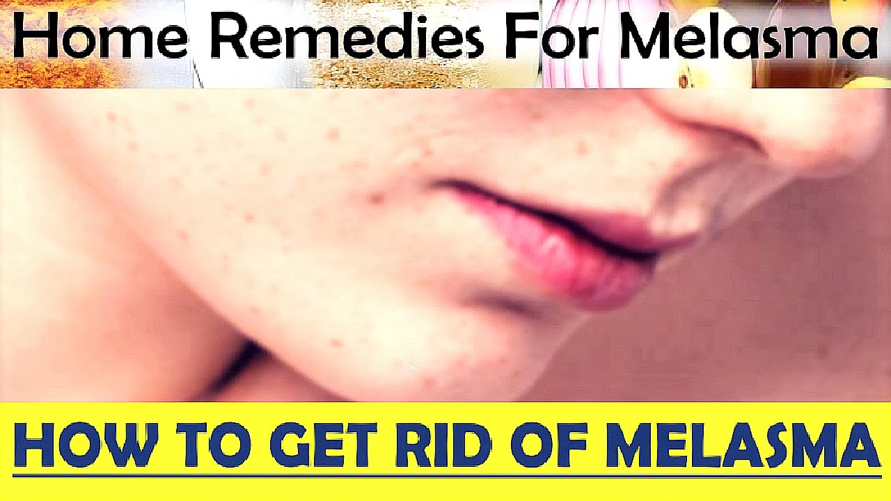 How To Get Rid Of Melasma | Home Remedies For Melasma - YouTube
