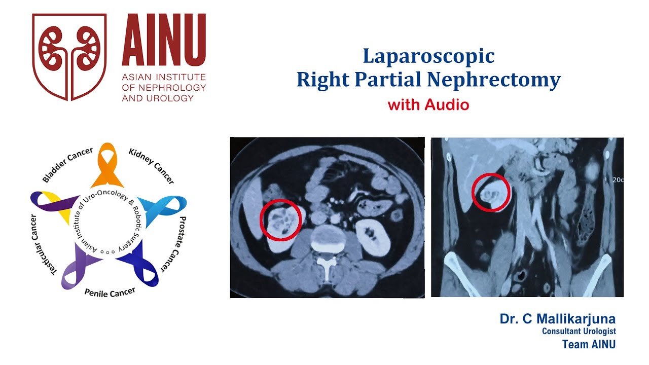 Laparoscopic Right Partial Nephrectomy (with Audio) | AINU Surgical ...