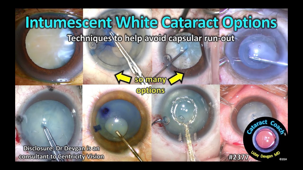 CataractCoach™ 2377: options for intumescent white cataracts - YouTube