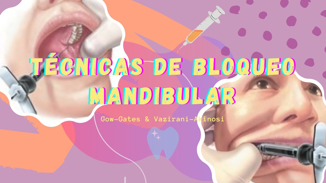 TÉCNICAS DE BLOQUEO MANDIBULAR: Gow-Gates y Vazirani-Akinosi - YouTube