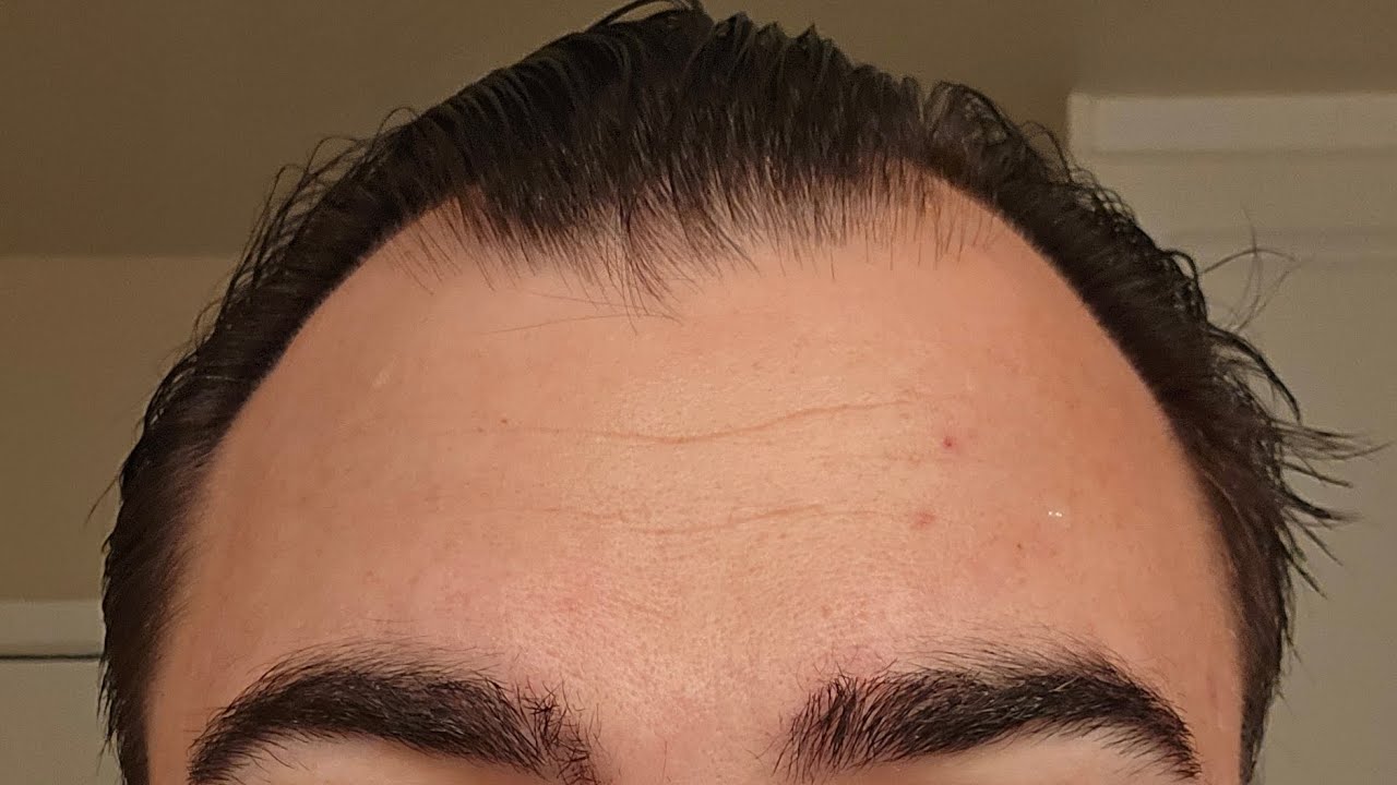 Hair Regrowth Journey - What I'm Doing To Regrow My Temples And Prevent ...