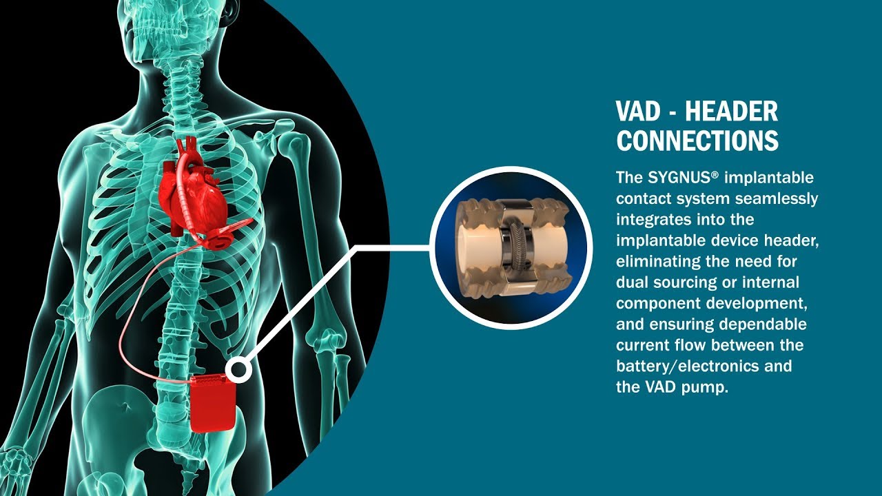 Electrical Contact Technology for Medical Active Implantables - YouTube