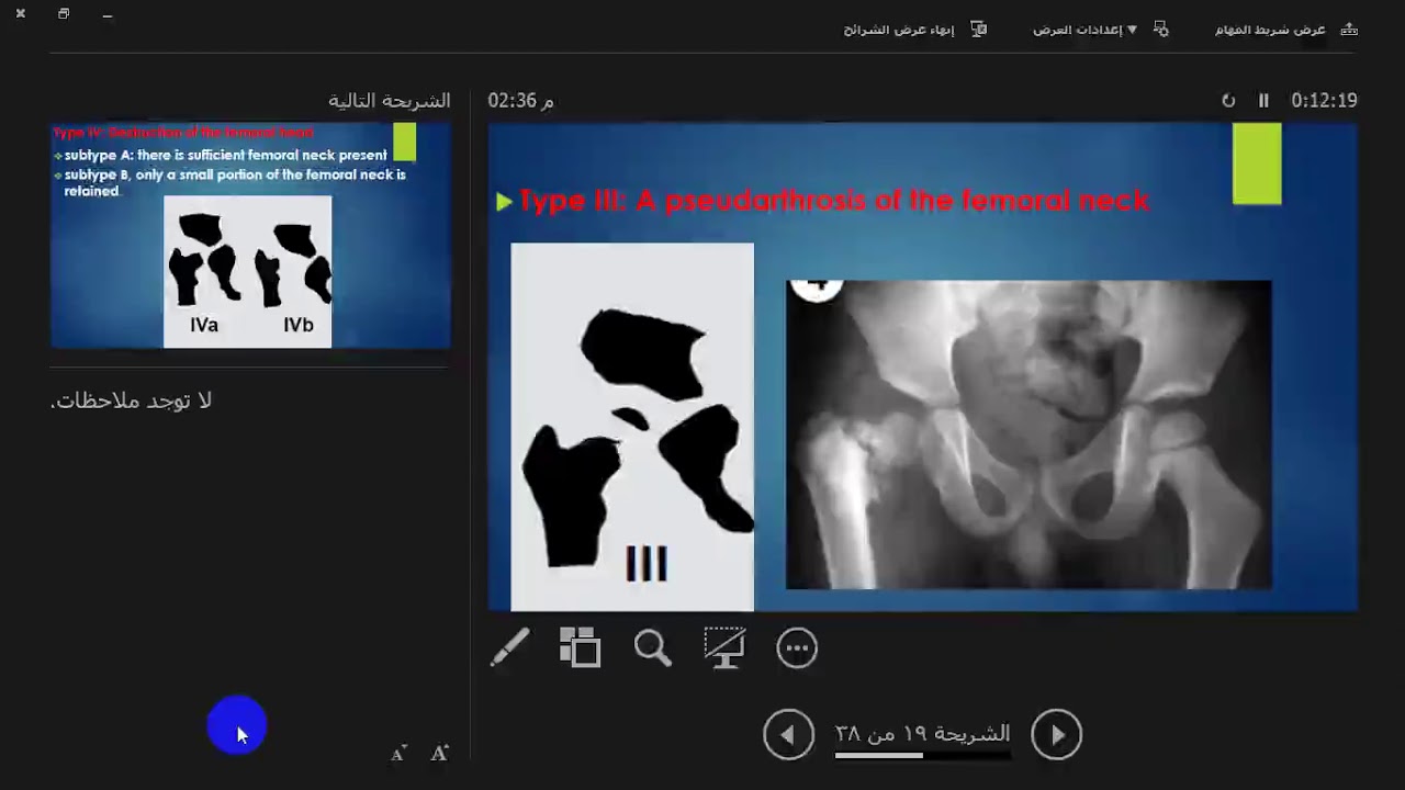 Pediatric septic hip Prof M Hosney - YouTube
