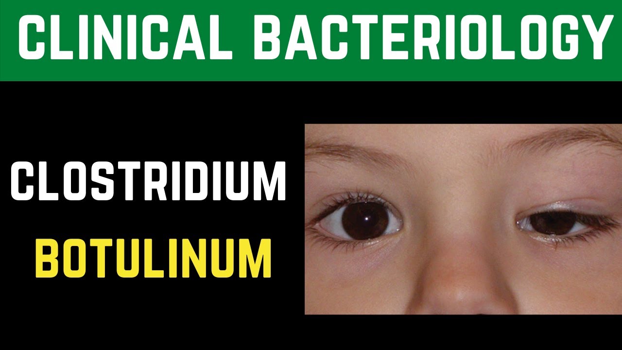 Clostridium Botulinum Clinical, Pathogenesis, Investigations, Treatment ...