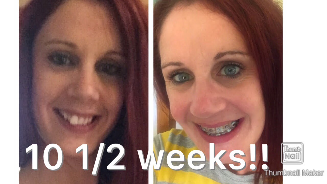 Update 10 1/2 weeks ! Overbite, gummy smile, double jaw surgery ...