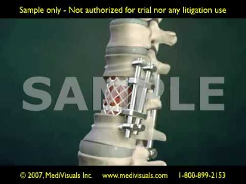 Thoracolumbar Spinal Fusion: 3D Medical Animation - YouTube