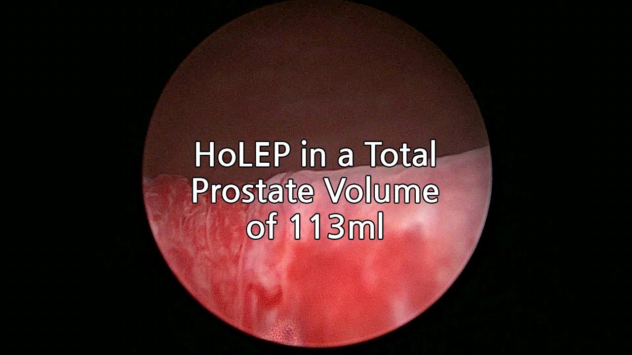 Routine HoLEP Procedure with Dr. Oh (113ml) - YouTube