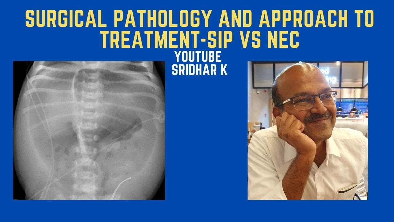Approach to treatment of neonatal gut perforation and surgical ...