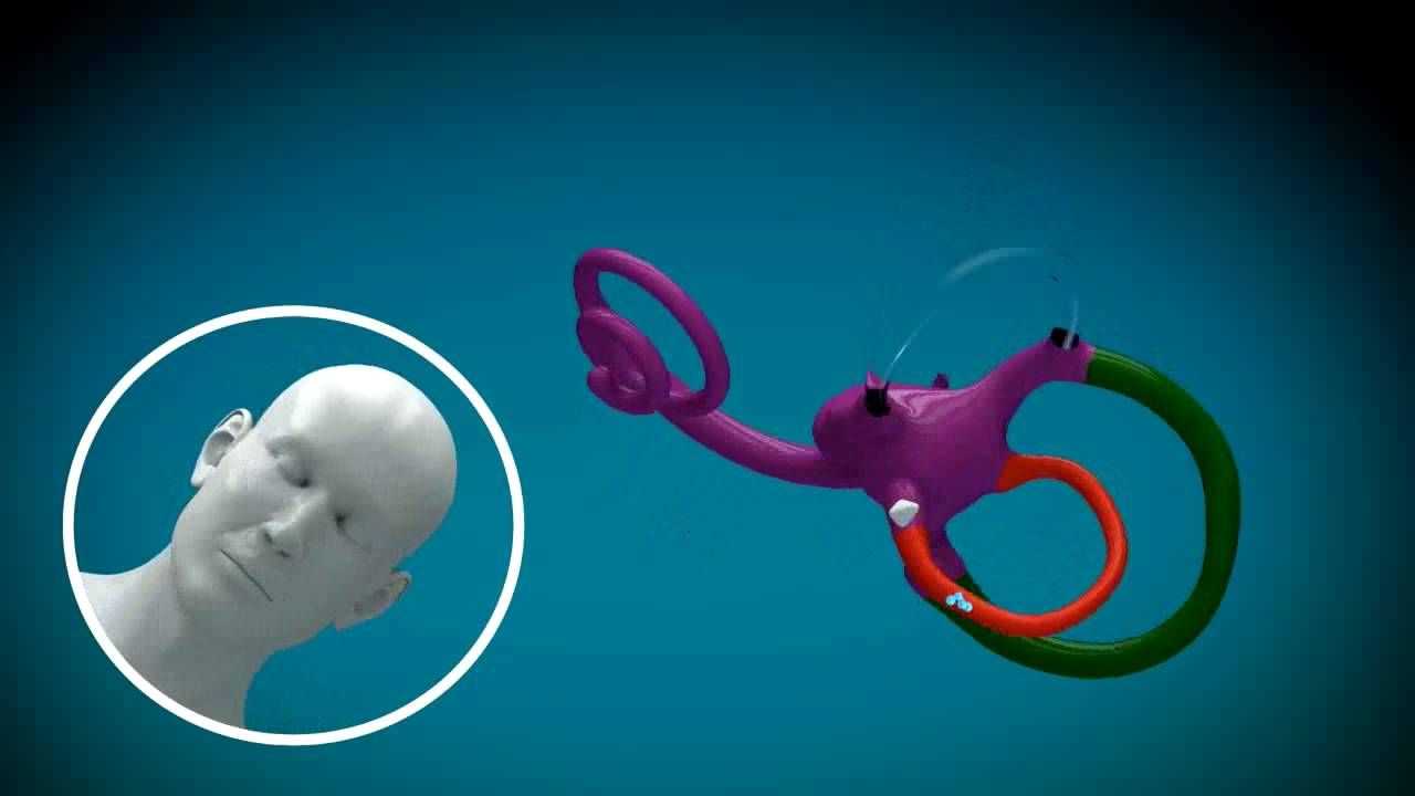 MUSC: BPPV Treatment Series (Left Gufoni for Left Cupulolithiasis ...