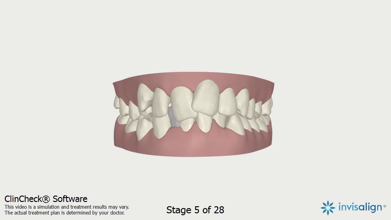 ClinCheck Example for a Complex Case - YouTube