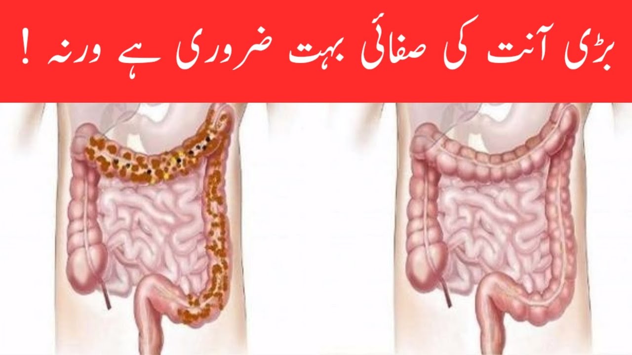 Bari Aant Ki Safai Karne Wali Ghizain | Bari Aant Ka Ilaj In Urdu ...