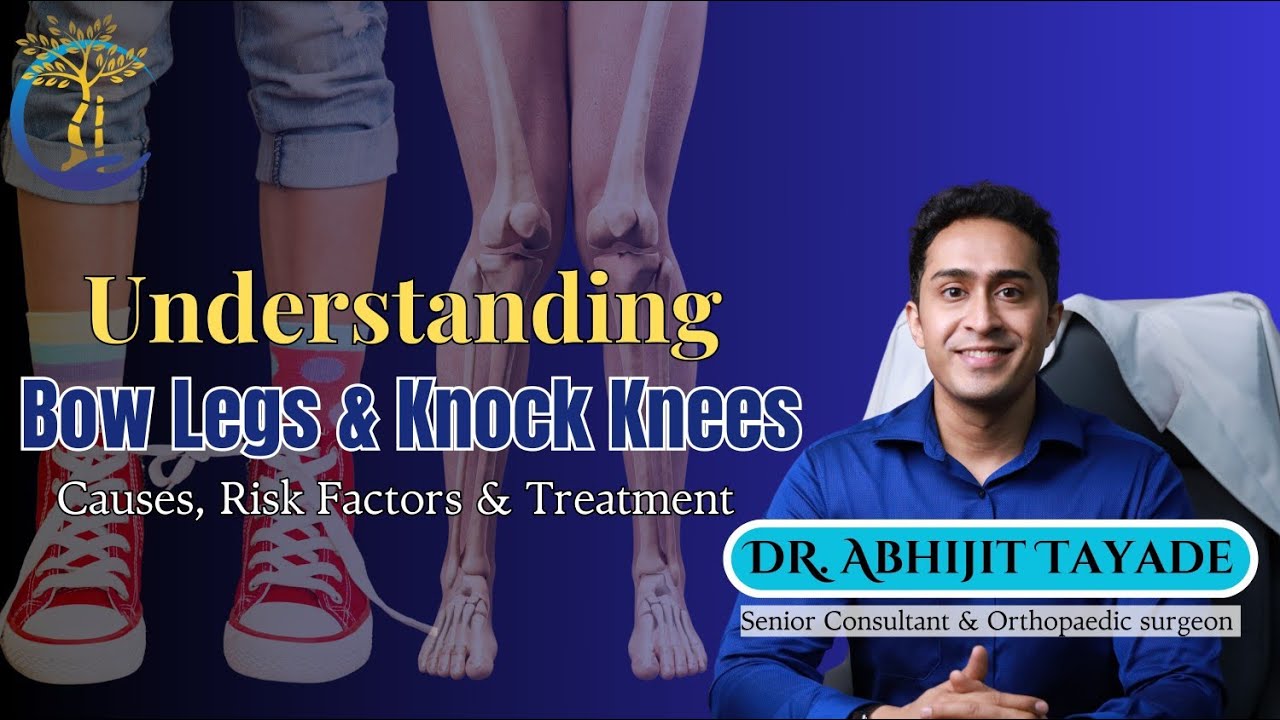 Understanding Bow Legs and Knock Knees | Causes | Risk factors ...