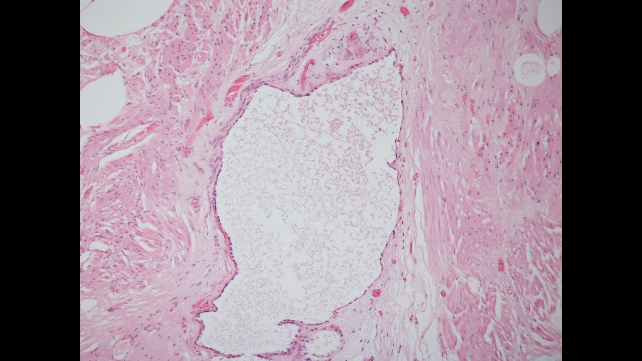 Endocervicosis - Pathology mini tutorial - YouTube