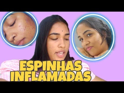 COMO ELIMINEI ESPINHAS INFLAMADA|CUIDADOS COM ROSTO ACNEICO - YouTube