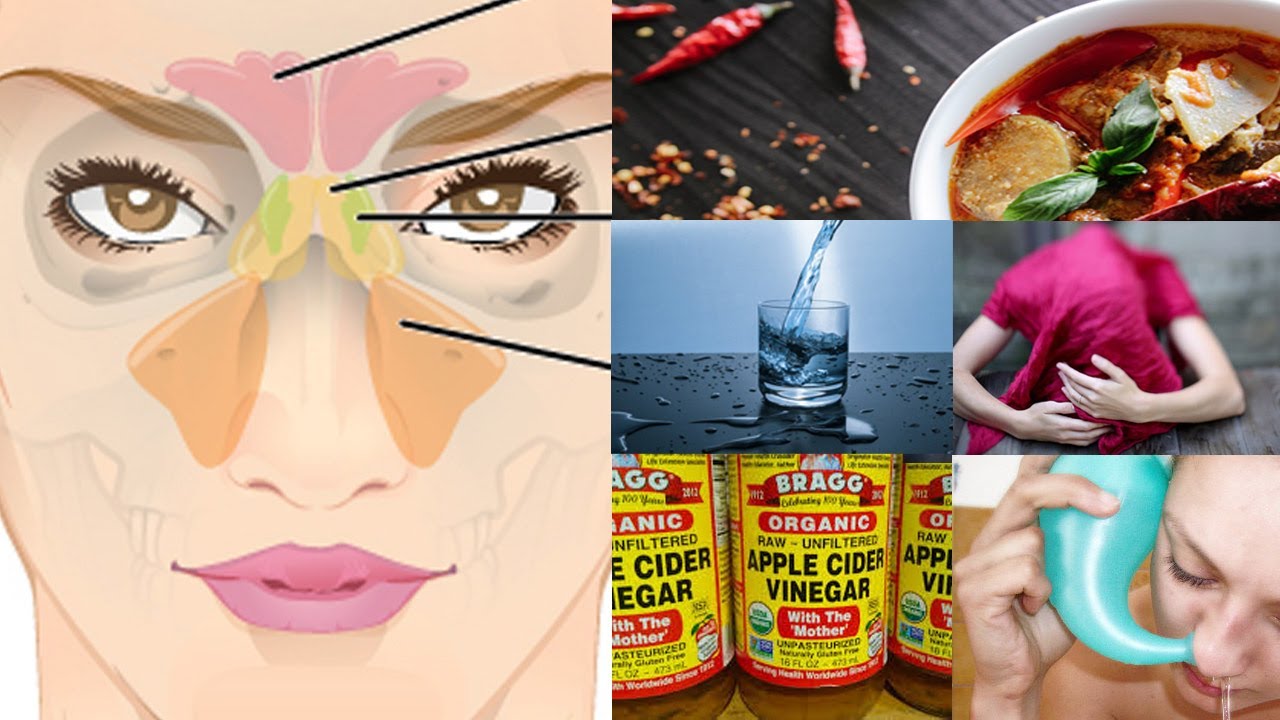 How to Cure Sinus Infection or Sinusitis by 5 Simple Home Remedies ...