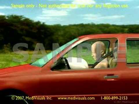 2D/3D Medical Animation: TBI - Traumatic Brain Injury Part I - YouTube