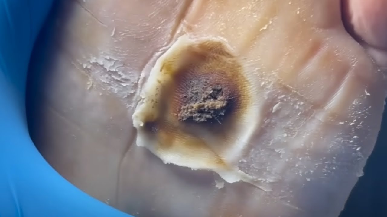 Wow! The Super Stress Free Plantar Wart Repair Process! - YouTube