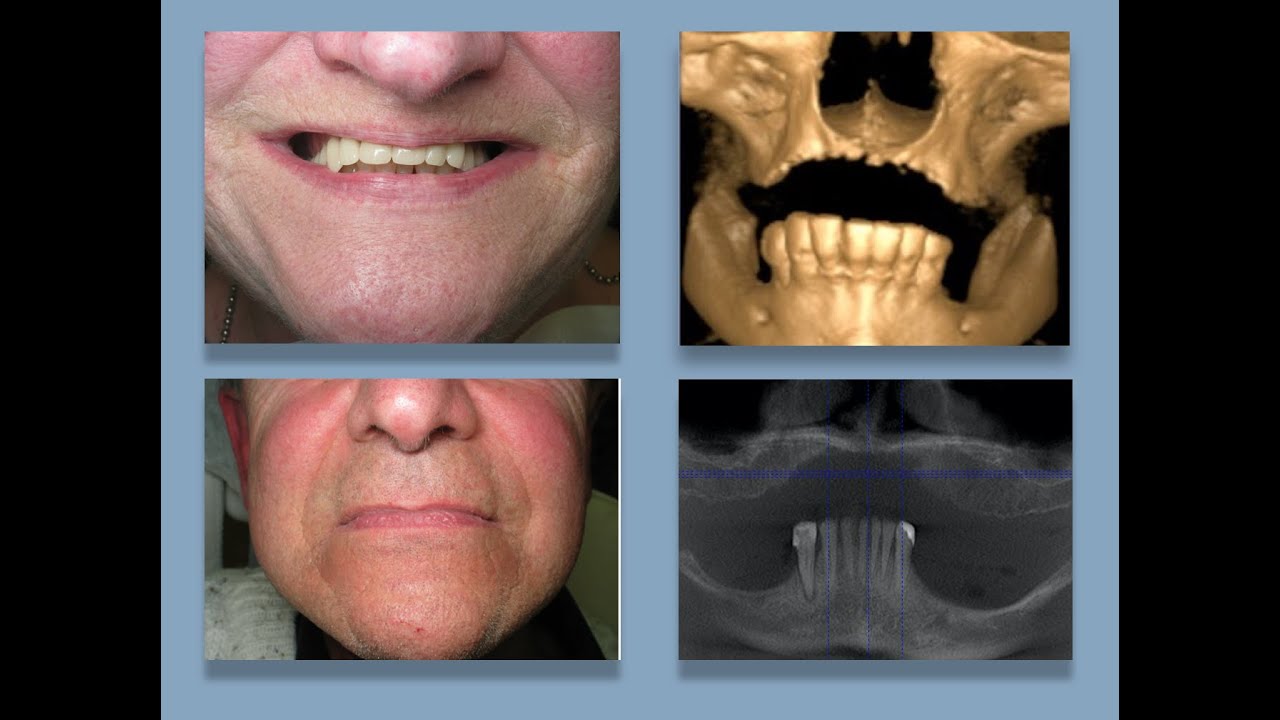 Traitement du syndrome de Kelly Conférence Anne Claire et Michel Metz ...