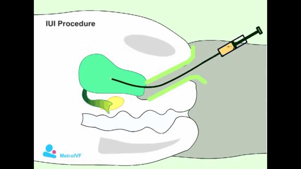 IUI procedure - YouTube