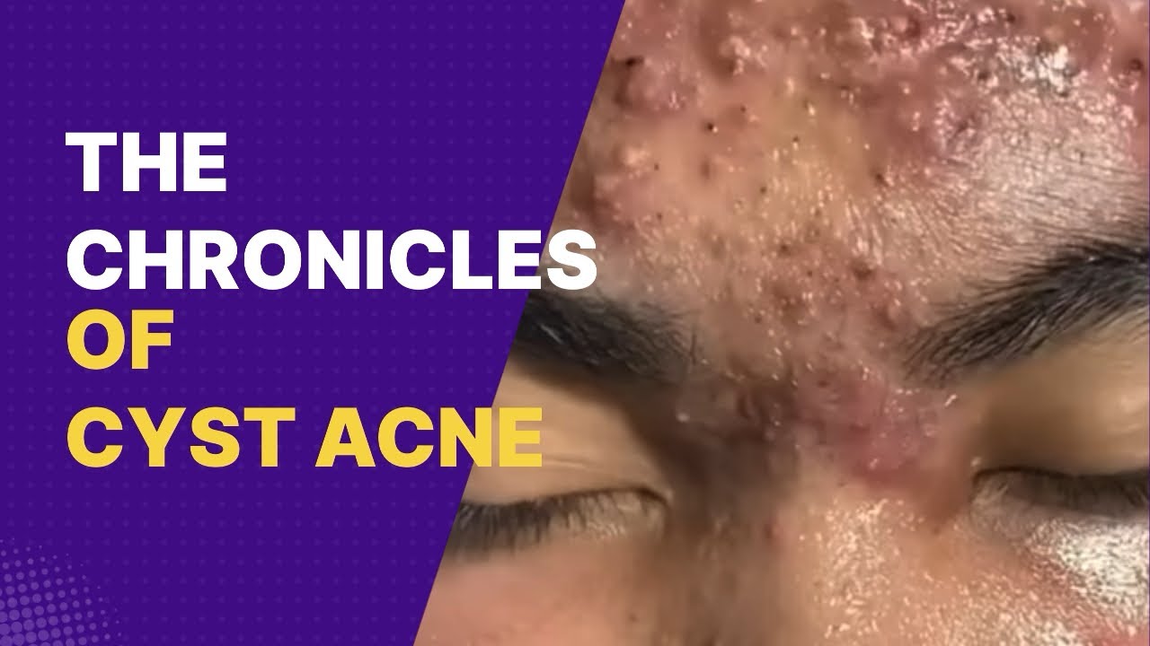 "Banish Acne: Proven Treatment Tips for Clear Skin!" |cystic acne ...