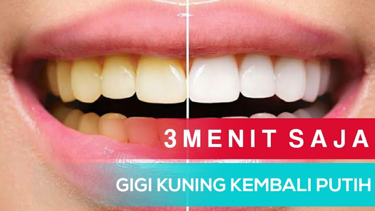cara memutihkan gigi | cara memutihkan gigi kuning | cara memutihkan gigi dengan bahan alami ...