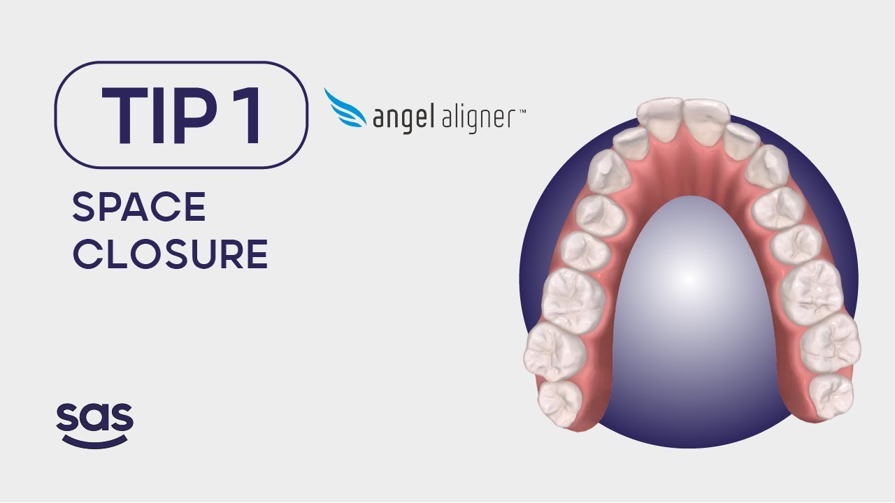 Tip 1. Angel Aligner - Space closure - YouTube