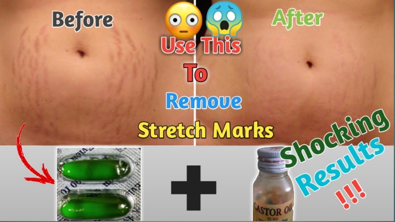 How to Remove Stretch Marks? | 3 Easy Steps | (Stretch Marks हटाने के 3 ...