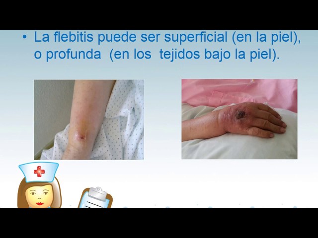 Tratamiento De Flebitis En El Brazo